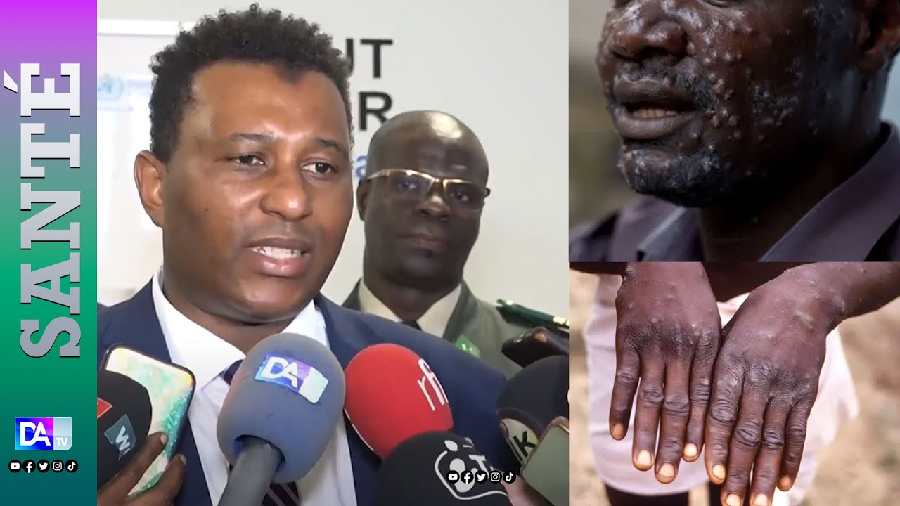 Alerte sur la variole du singe : « Les virus tout comme les germes n ...